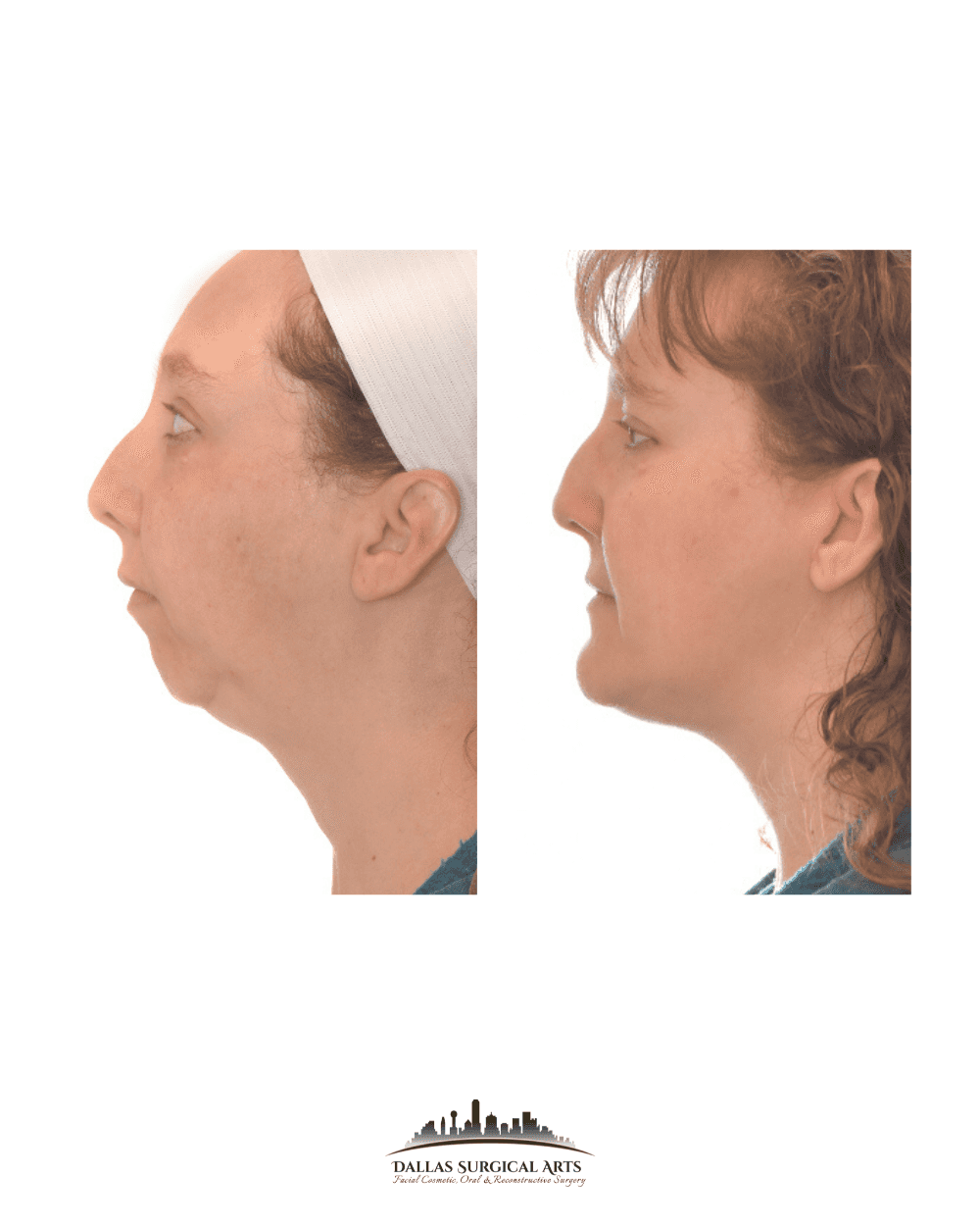 TMJ Surgery | Oral Surgery in Dallas