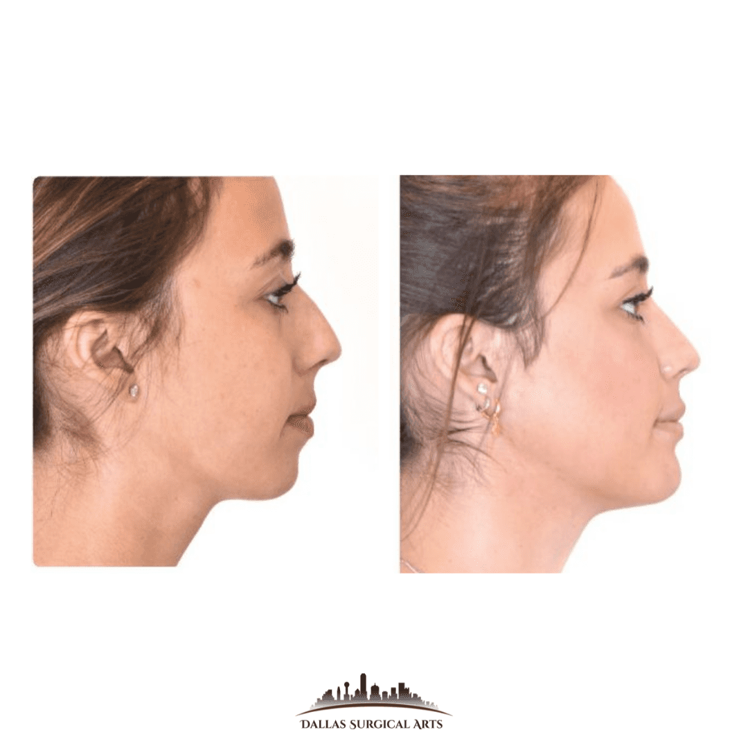 TMJ Surgery | Dallas Oral Surgery